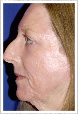 ActiveFX™ Fractional Laser Resurfacing | Skin Spectrum
