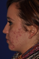 Skin Rejuvenation Results Tucson, AZ | Skin Spectrum